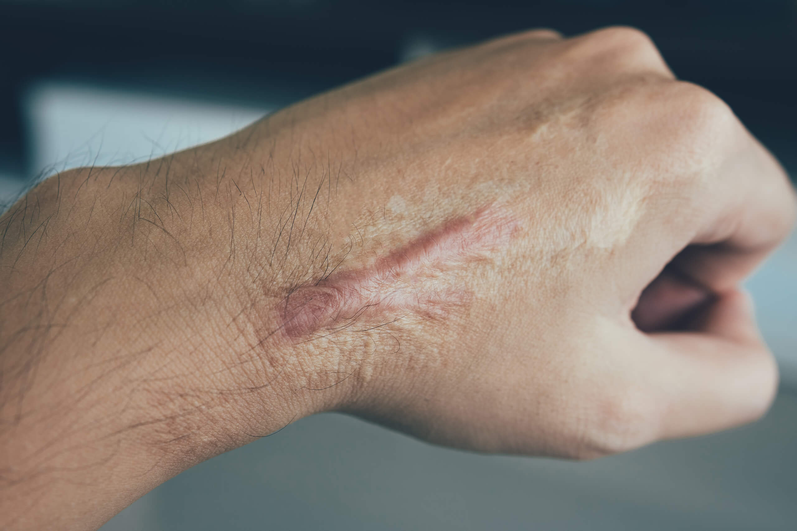 From Wound to Wellness: The Evolution of Hand Surgery Scars