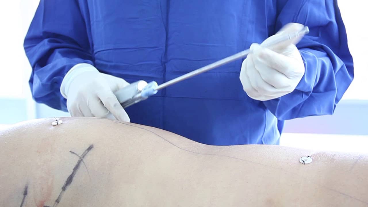 Liposuction on Hips and Thighs Techniques